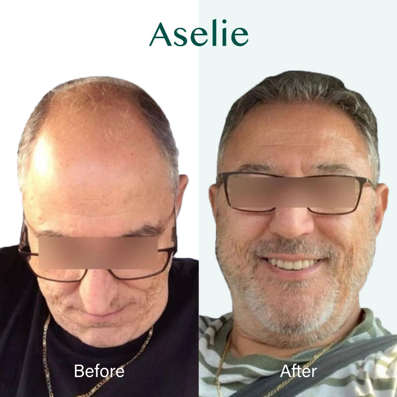 Hair Transplant in Istanbul - Doctors' experience: 22 years - Aselie
